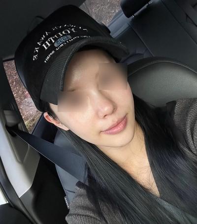 코끝(자가조직)|시술방법 선택 안함 시술・수술후기 by 냥이WhHEh | 바비톡