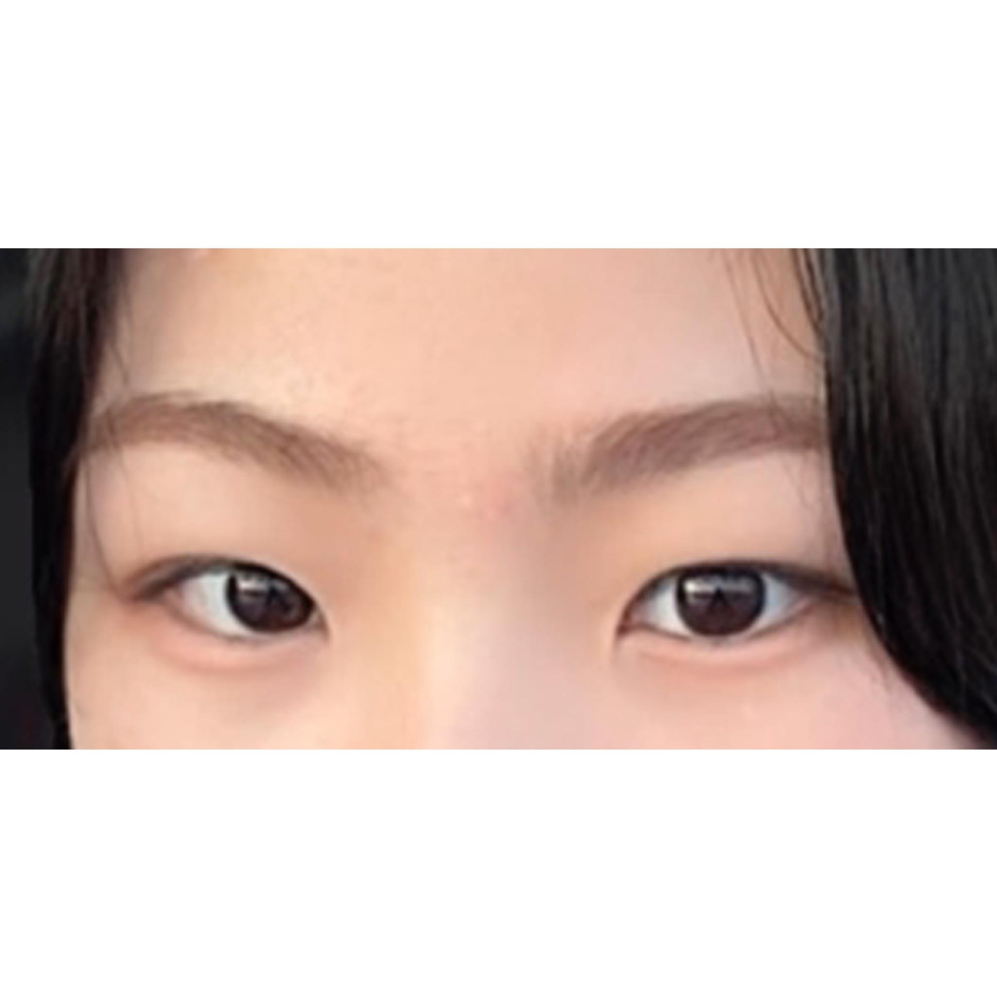 히트눈성형 모음집.zip 시술 후기∙가격∙효과 by 히트성형외과의원 - 바비톡